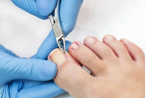 Ingrown Toenail Removal — 2 Right Feet Podiatry | Yarra Valley Family ...