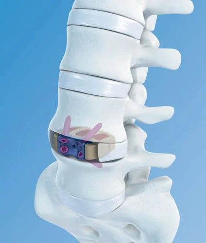 Anterior Lumbar Interbody Fusion (ALIF) — Betsy Grunch, MD