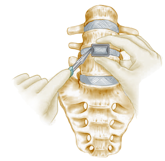 Anterior Lumbar Interbody Fusion (ALIF) — Betsy Grunch, MD