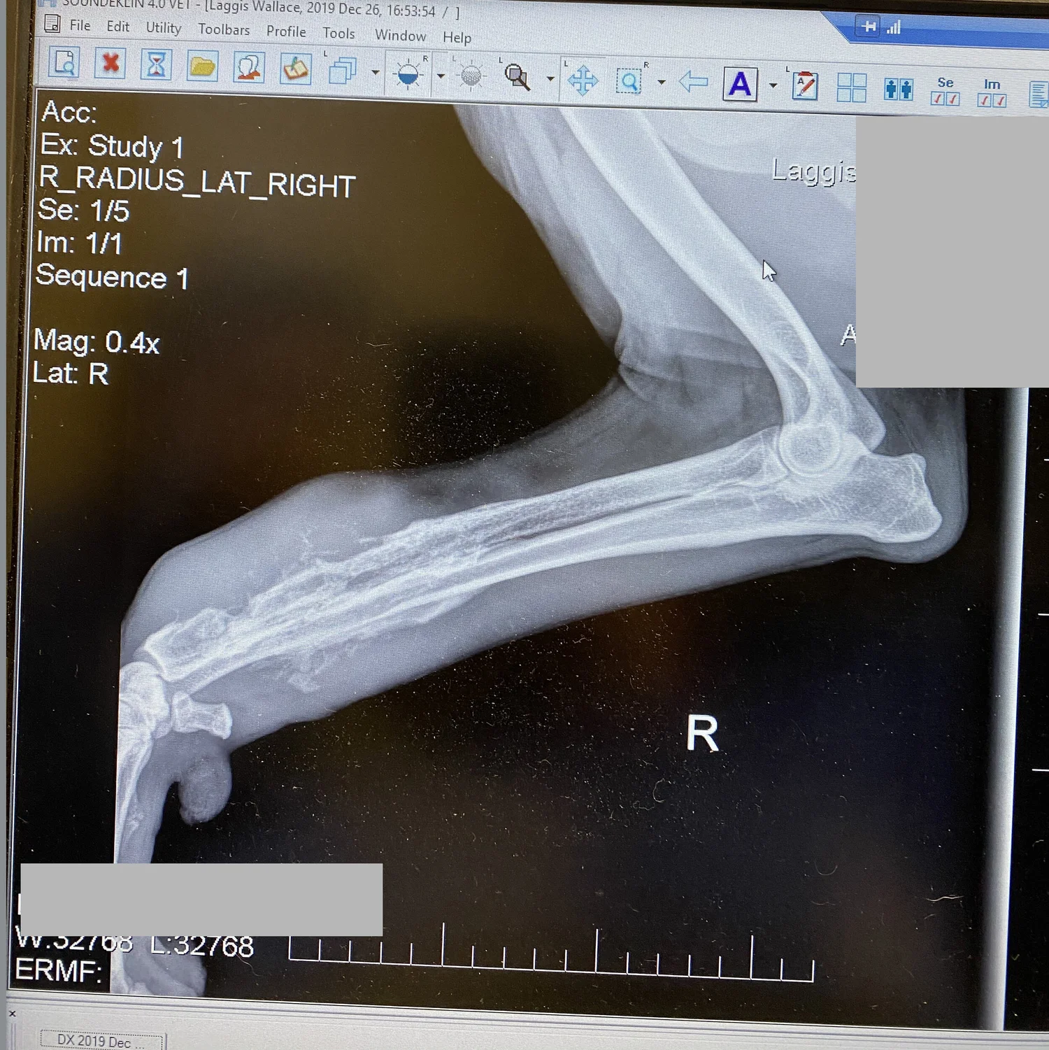 Wallace’s Story: A Journey Through an Osteosarcoma Diagnosis ...