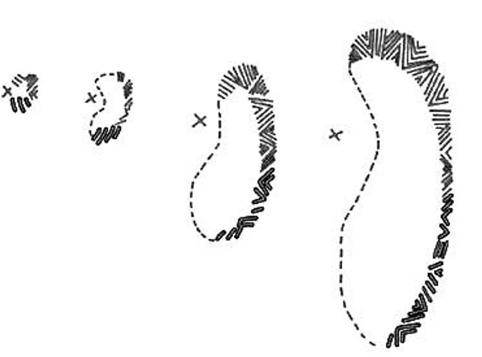 What is persistent Aura Without Infarction? 2023