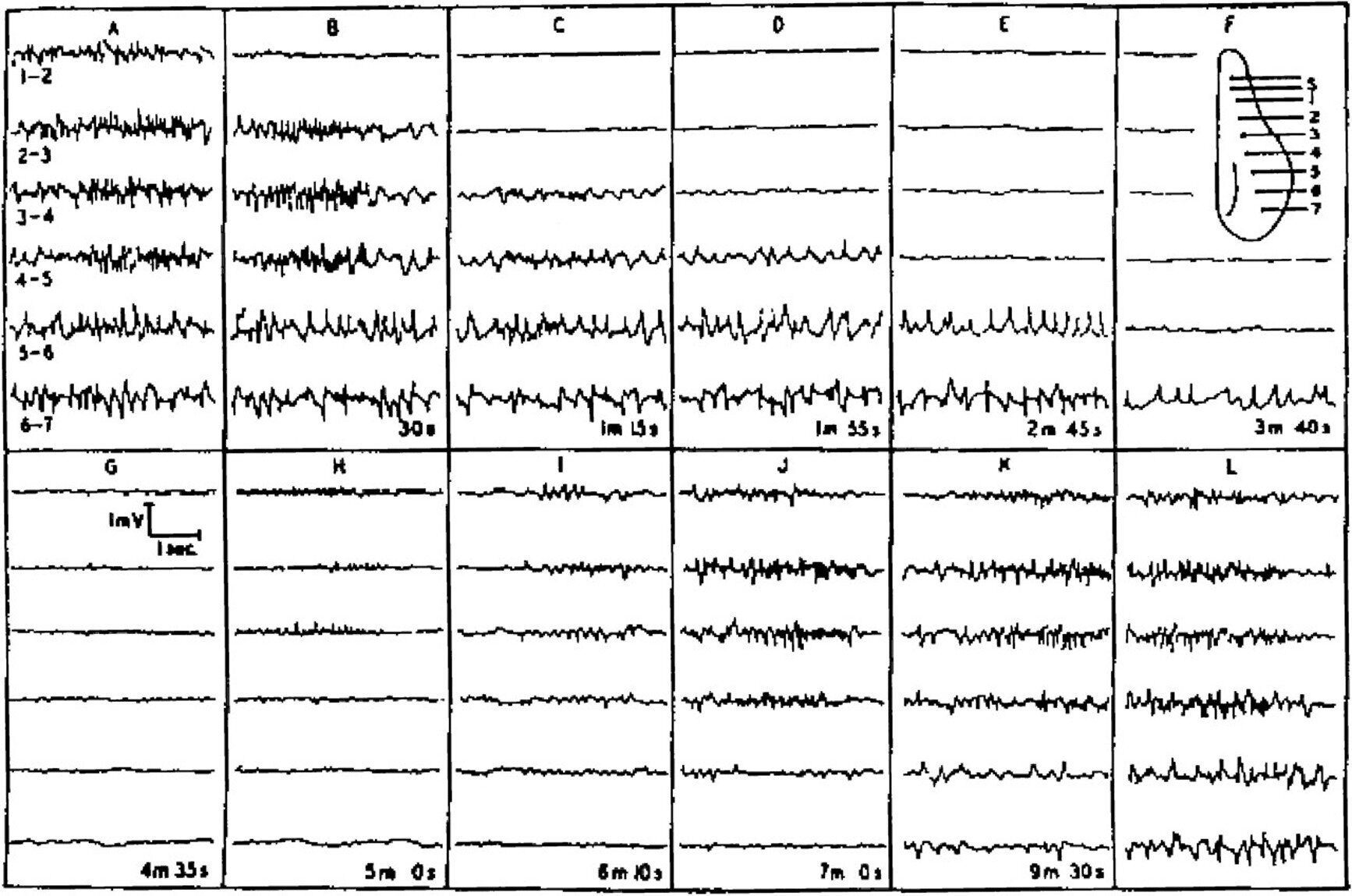 Migraine with Aura 2023