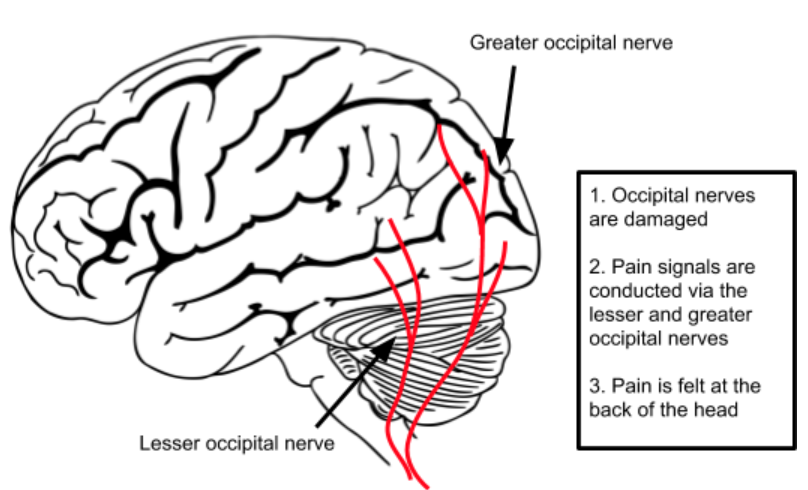 Headaches: Advanced Page — Concussion Alliance