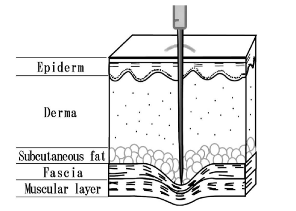 Acupuncture — Concussion Alliance