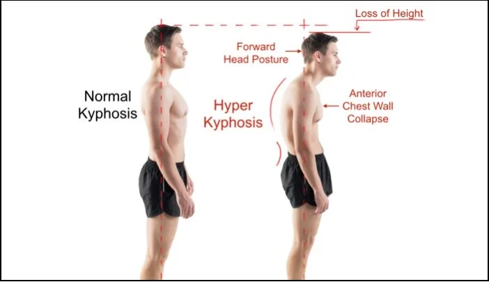 Can poor posture affect your height? — SpinalCare Sydney Olympic Park | Chiropractic and Massage