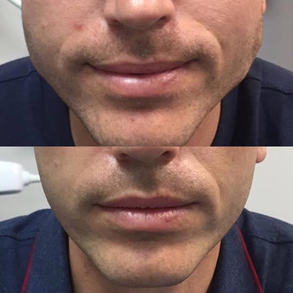 What You Need To Know About Masseter Reduction Slimming The Jawline What You Need To Know About Masseter Reduction Slimming The Jawline