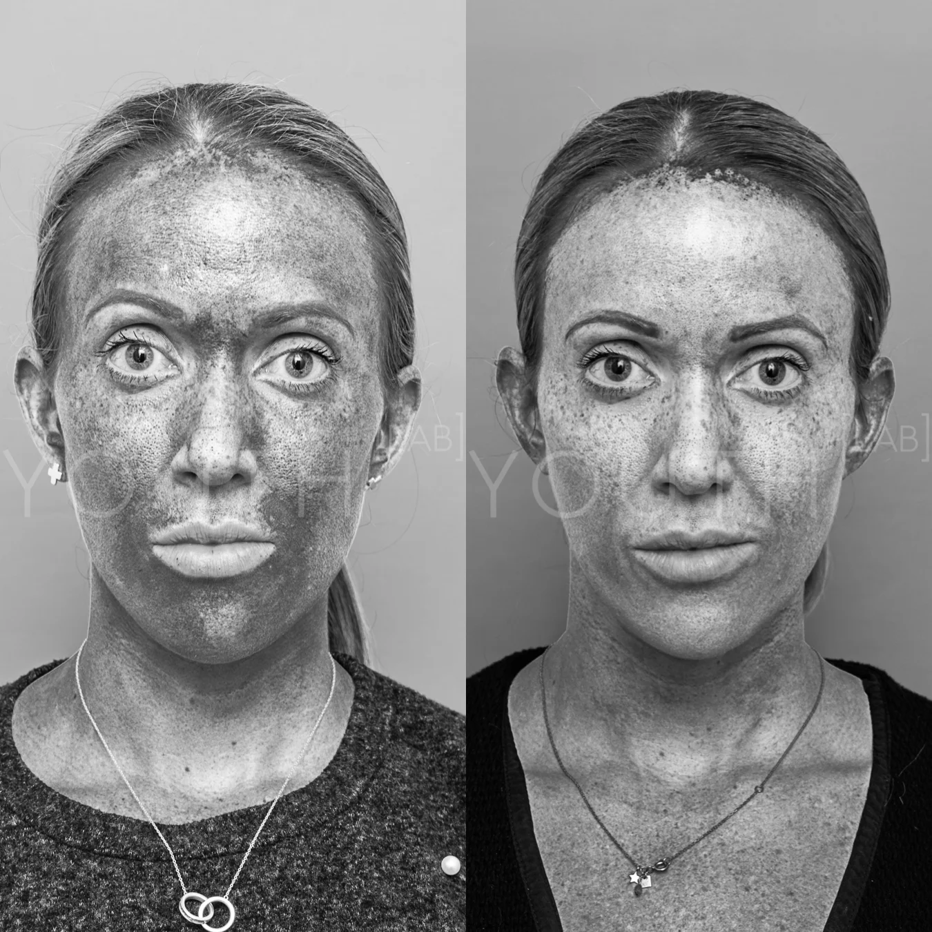 Bbl Broadband Light Therapy Cost | Shelly Lighting