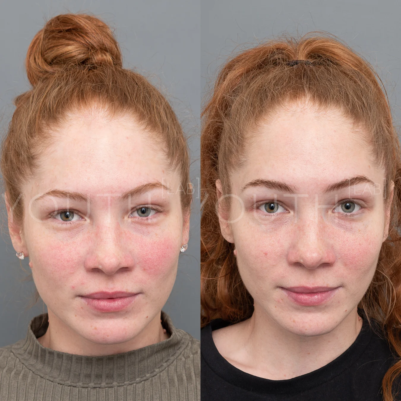 Bbl Broadband Light Therapy Cost | Shelly Lighting