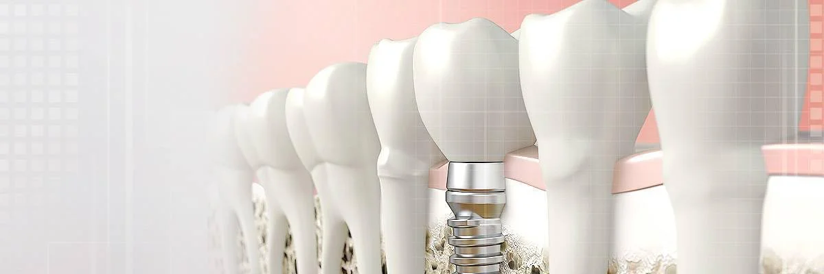 San Diego Ca Dental Implants Bella Vita Dental Bella Vita Dental