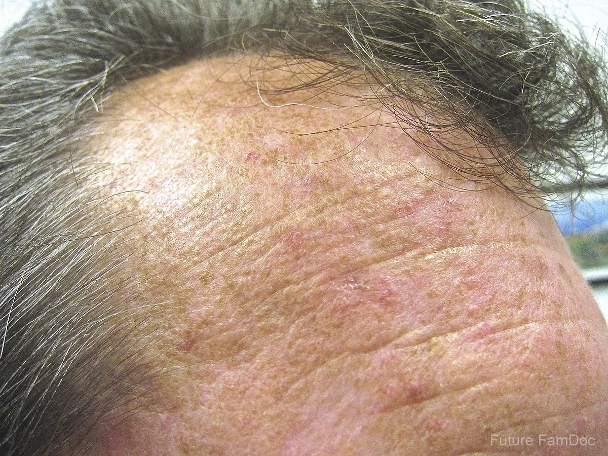 Actinic Keratosis Gateway Dermatology