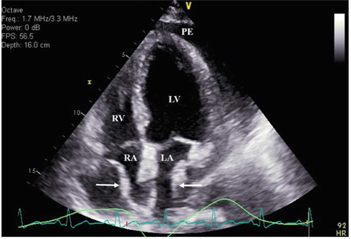 Intern Ultrasound of the Month: Cardiac Tamponade — University ...