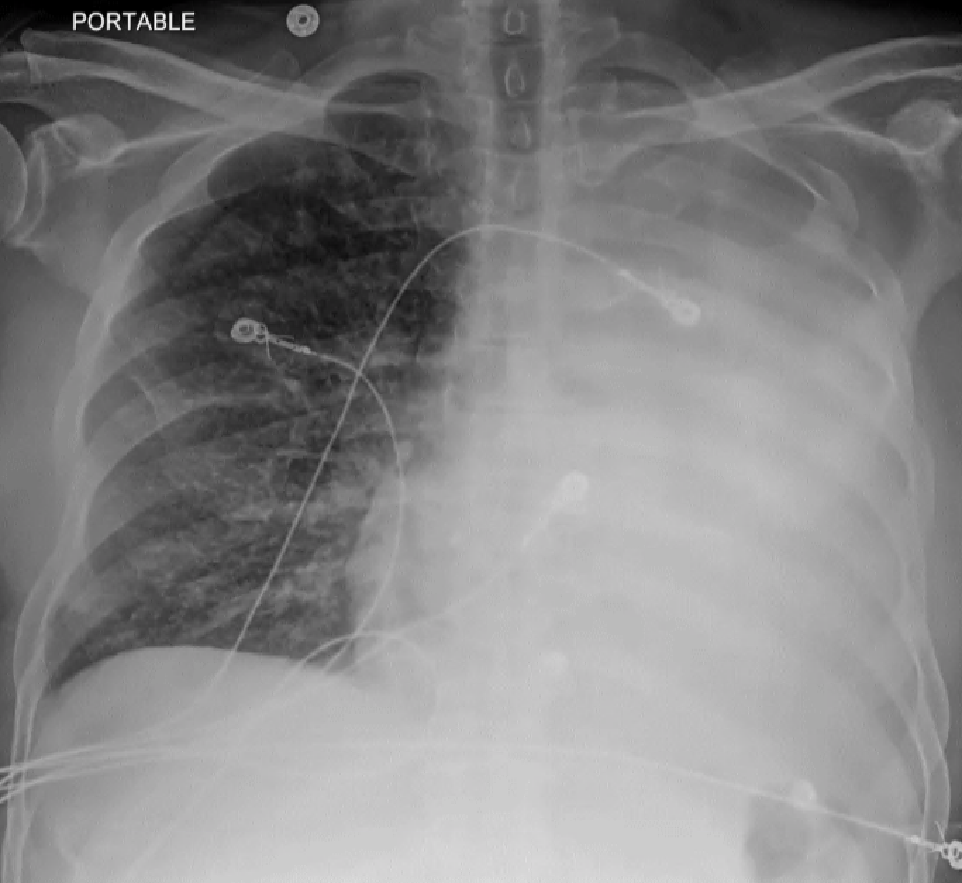 Thoracic Ultrasound & Complex Pleural Effusions — University Hospitals ...