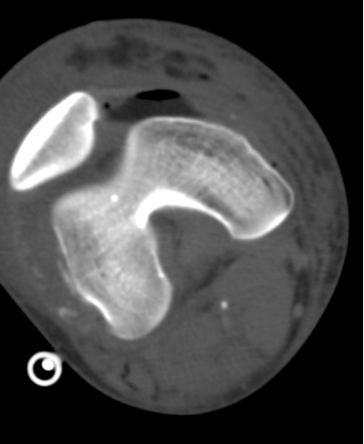 EBM Series: Traumatic Arthrotomy — University Hospitals Emergency ...