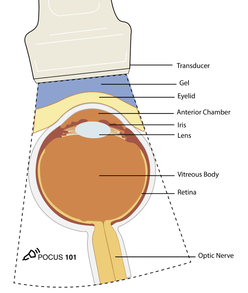 Intern Ultrasound of the Month: Retinal Detachment — University ...
