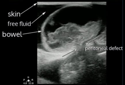 Intern Ultrasound of the Month: Inguinal Hernia — University Hospitals ...