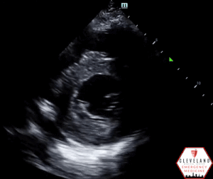 Intern Ultrasound of the Month: POCUS & Regional Wall Motion ...