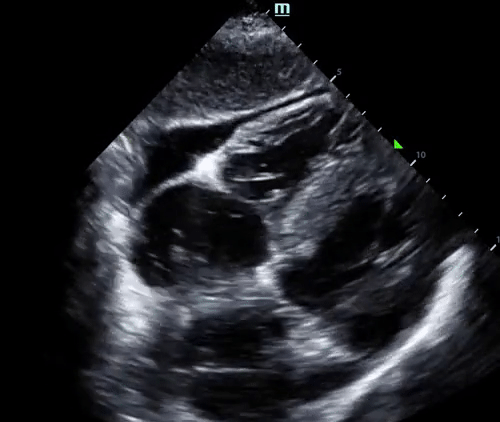 Intern Ultrasound of the Month: POCUS & Regional Wall Motion ...