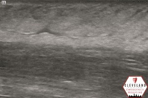 Intern Ultrasound of the Month: Cellulitis of the Lower Extremity ...