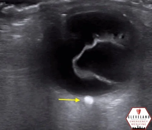 Ultrasound of the Month: Central Retinal Artery Occlusion — University ...