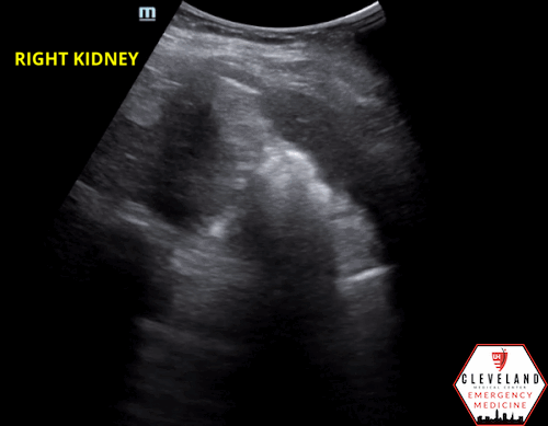 Intern Ultrasound of the Month: A Case of Hydronephrosis Leading to the ...