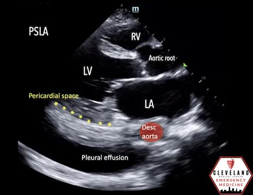 Intern Ultrasound of the Month: A Left Atrial Aneurysm & Review of the ...