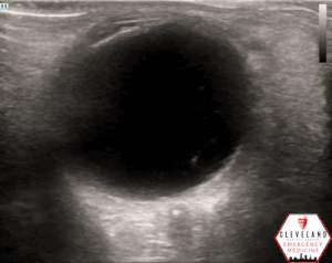 Ultrasound of the Month: Central Retinal Artery Occlusion — University ...