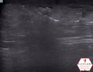 Intern Ultrasound of the Month: Cellulitis of the Lower Extremity ...