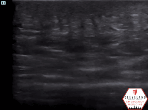 Intern Ultrasound of the Month: To Drain or Not to Drain? Ultrasound ...