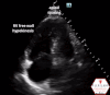 Intern Ultrasound of the Month: A Sign of Acute Pulmonary Embolism ...