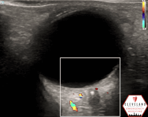 Ultrasound of the Month: Central Retinal Artery Occlusion — University ...