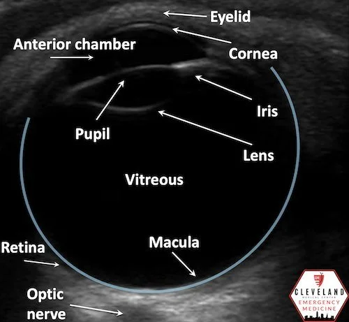 Ultrasound of the Month: Central Retinal Artery Occlusion — University ...