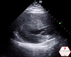Intern Ultrasound of the Month: Left Ventricular Hypertrophy ...
