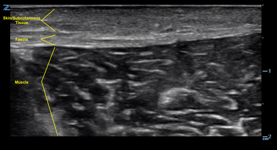 Intern Ultrasound of the Month: To Drain or Not to Drain? Ultrasound ...