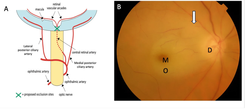 Ultrasound of the Month: Central Retinal Artery Occlusion — University ...