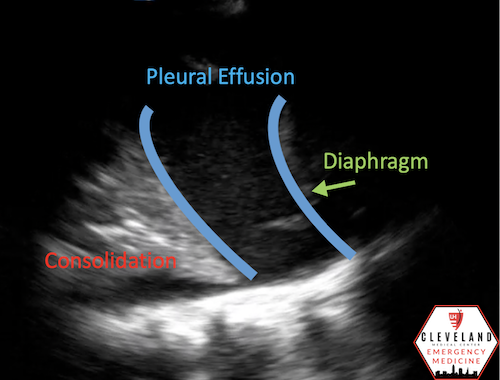Intern Ultrasound of the Month: Post-Viral Pneumonia — University ...