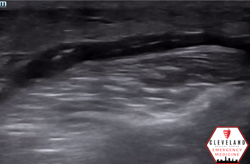Intern Ultrasound of the Month: Cellulitis of the Lower Extremity ...