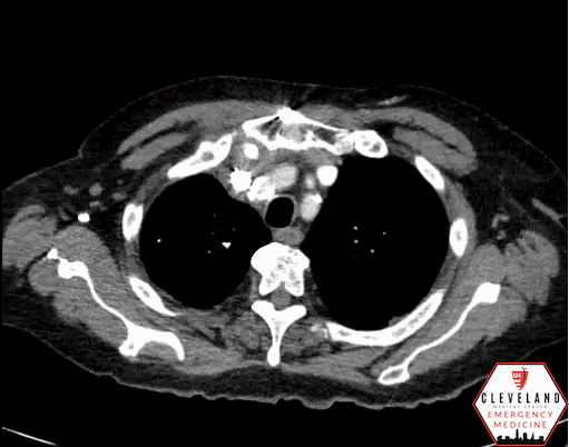 An Expanding Lung Mass & Assessment for Consolidations on Lung ...
