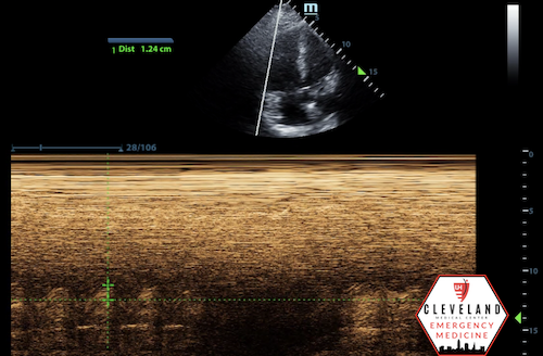 Intern Ultrasound of the Month: A Sign of Acute Pulmonary Embolism ...