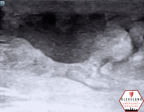 Intern Ultrasound of the Month: Cellulitis of the Lower Extremity ...
