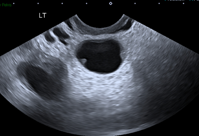 Intern Ultrasound of the Month: A Case of Hydronephrosis Leading to the ...