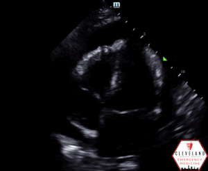 Intern Ultrasound of the Month: Cardiac Tamponade — University ...