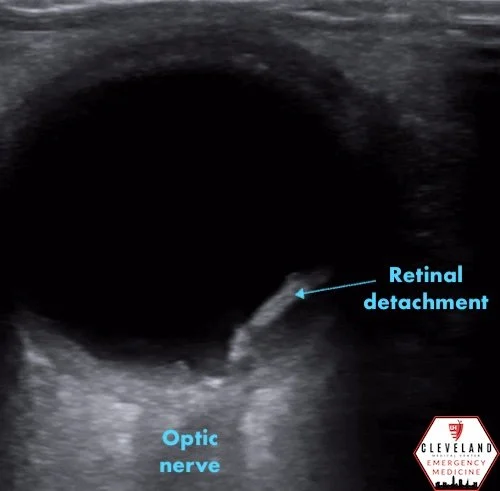 Intern Ultrasound of the Month: Retinal Detachment — University ...