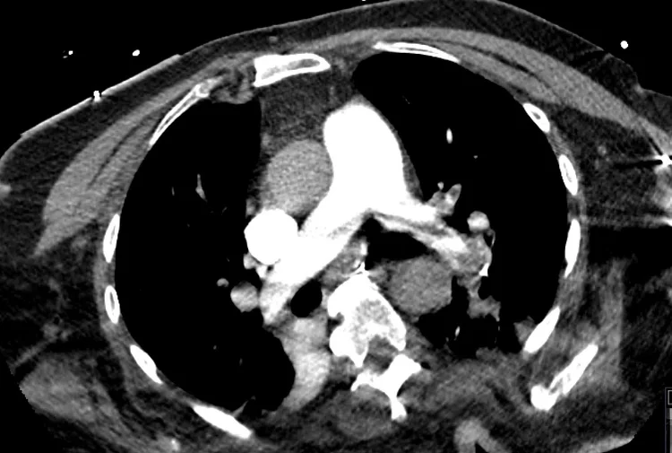 Intern Ultrasound of the Month: A Sign of Acute Pulmonary Embolism ...