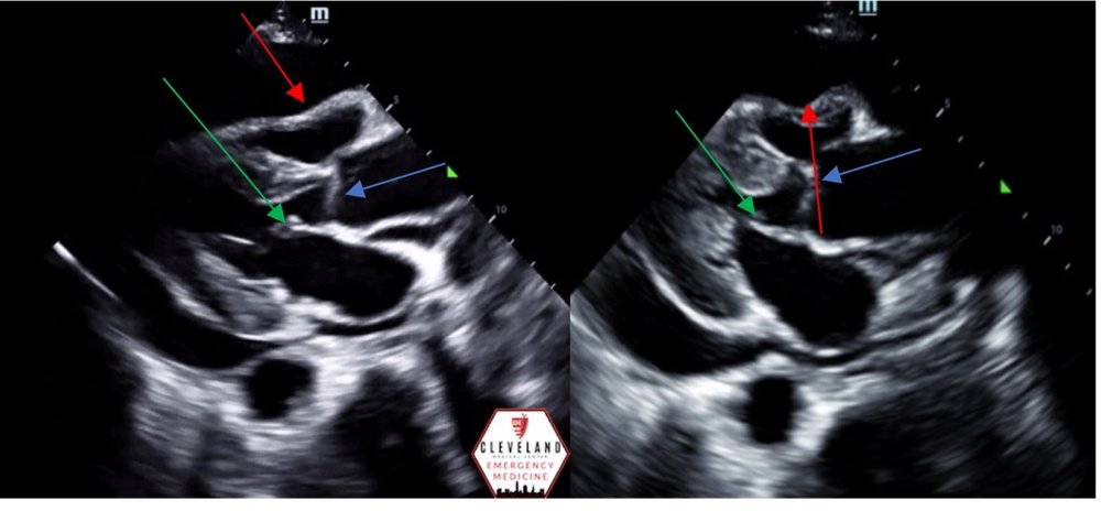 Intern Ultrasound of the Month: Cardiac Tamponade — University ...