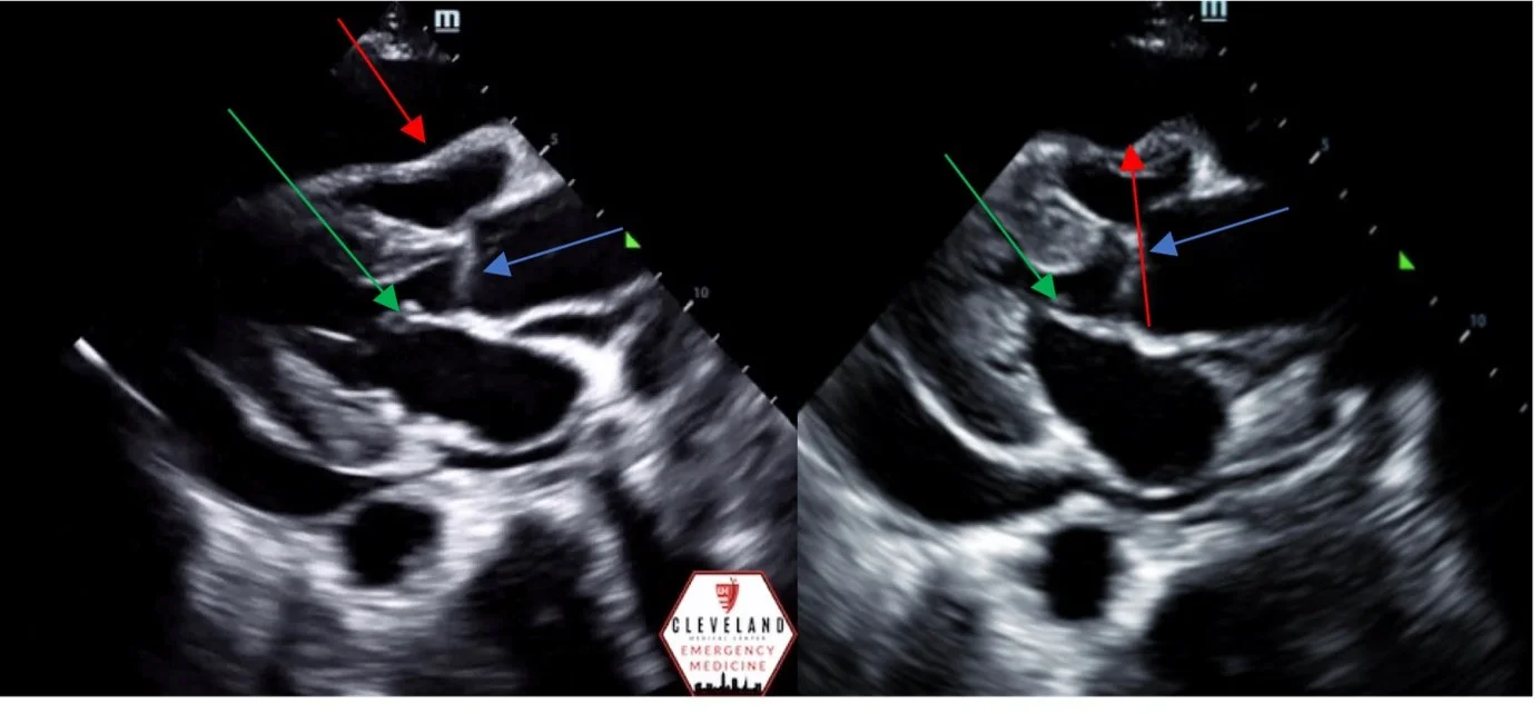 Intern Ultrasound of the Month: Cardiac Tamponade — University ...