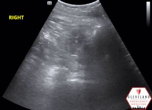 Intern Ultrasound of the Month: Hydronephrosis — University Hospitals ...