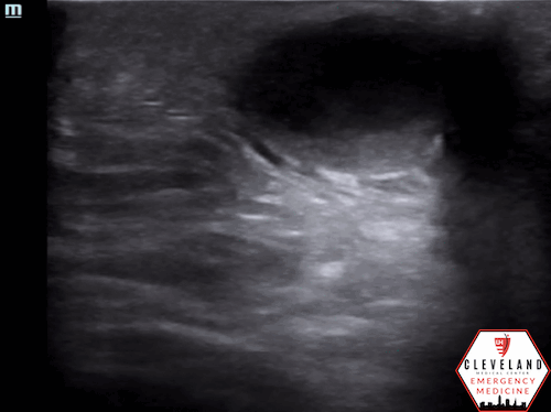 Intern Ultrasound of the Month: To Drain or Not to Drain? Ultrasound ...