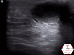 Intern Ultrasound of the Month: To Drain or Not to Drain? Ultrasound ...