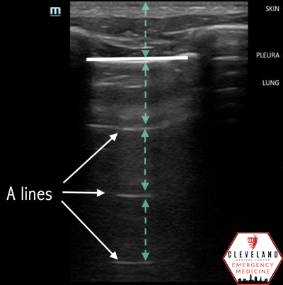 An Expanding Lung Mass & Assessment for Consolidations on Lung ...