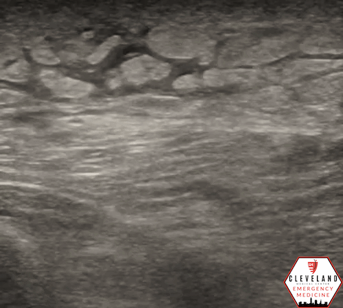 Intern Ultrasound of the Month: Cellulitis of the Lower Extremity ...